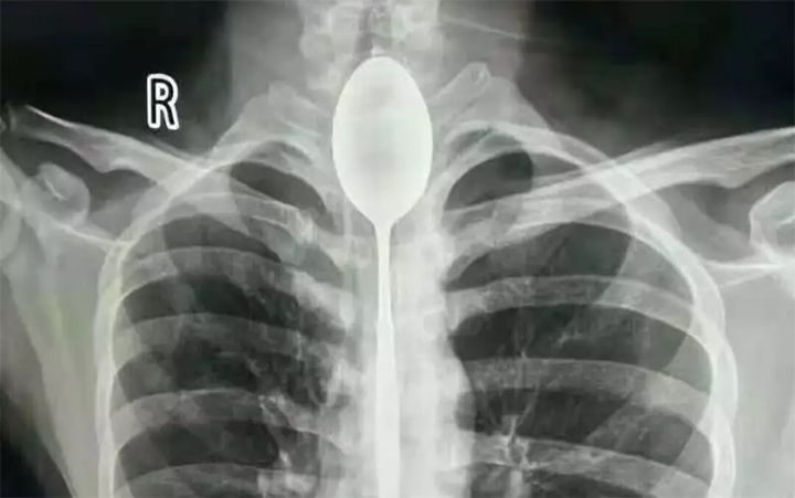 Medical Trivia: Lung-Shaped Clots and a Spoon in the Esophagus - UHSA ...